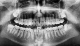 Ce sunt maselele de minte si cum trebuie sa procedam in ceea ce le ...